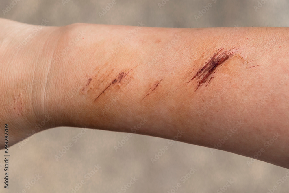 The wound form scabs on hand and arm. The wound happen during woman ...