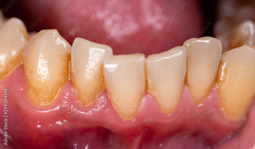 Lower teeth with plaque around them, closeup Stock Photo | Adobe Stock