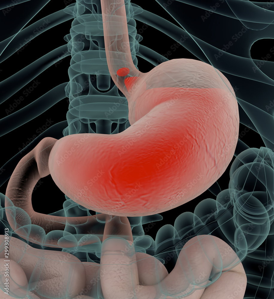 Anatomy illustration of gastric acid or heartburn, inflamed red stomach ...