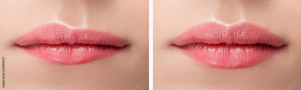 Before and after lips filler injections. Beauty plastic augmentation ...