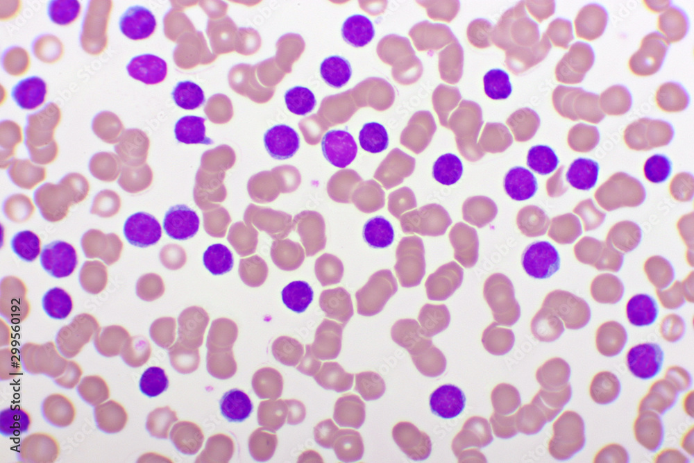 Blood picture of chronic lymphocytic leukemia or CLL, analyze by ...
