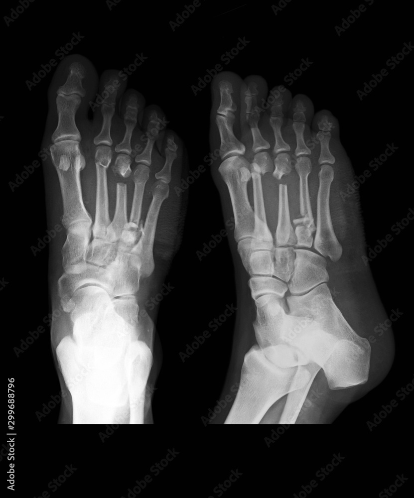Poster Computed radiography (CR) of foot, anteroposterior(AP) and ...