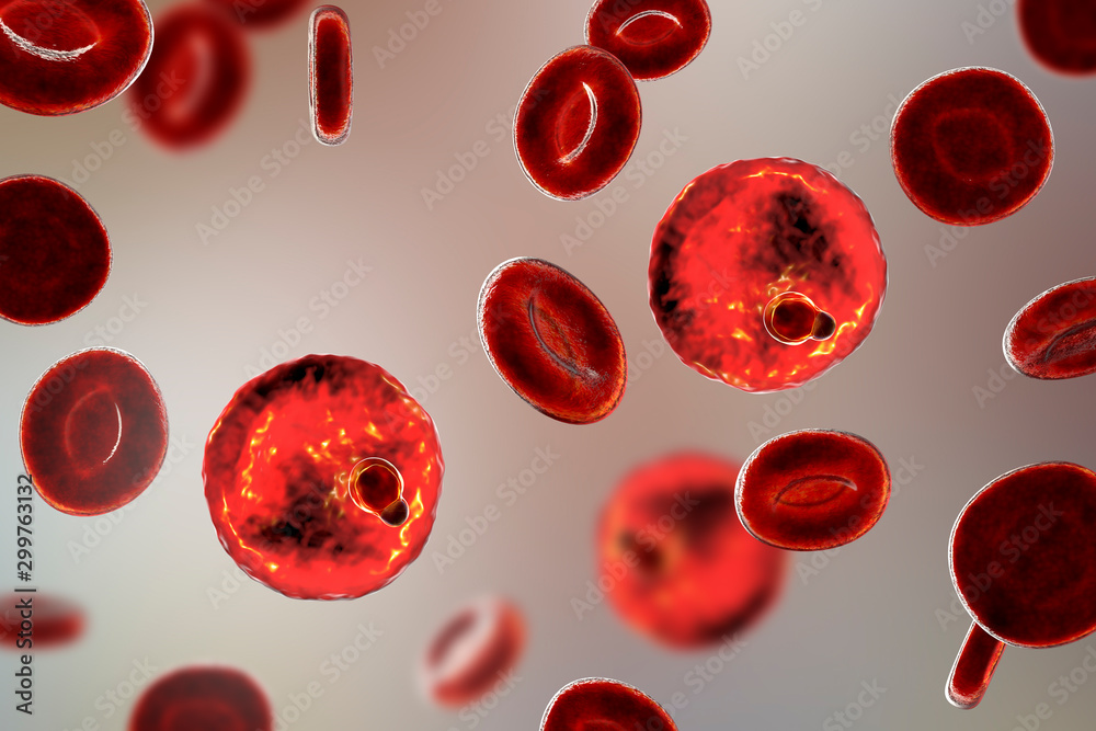 The malaria-infected red blood cell. 3D illustration showing parasite ...