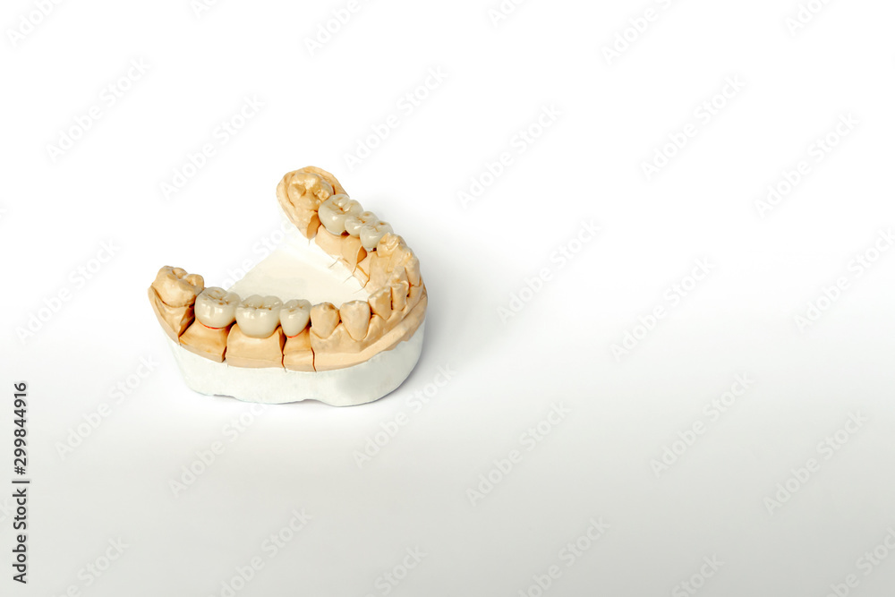 orthopedic dentistry. tooth replacement concept. dental prosthetics ...
