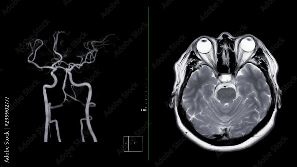 MRA Brain or Magnetic resonance angiography of Cerebral artery in the brain compare axial T2W ...