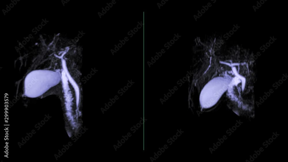Magnetic resonance cholangiopancreatography or MRCP 3D MIP image to ...