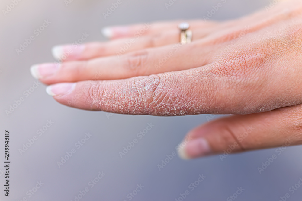 Dry cracked skin macro closeup of index finger of female young woman's ...