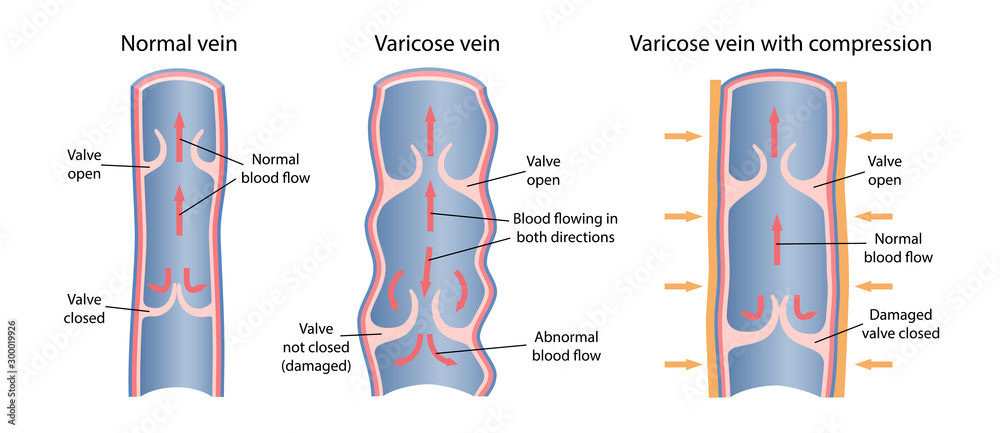 Treatment of varicose veins by compression. The scheme of venous ...