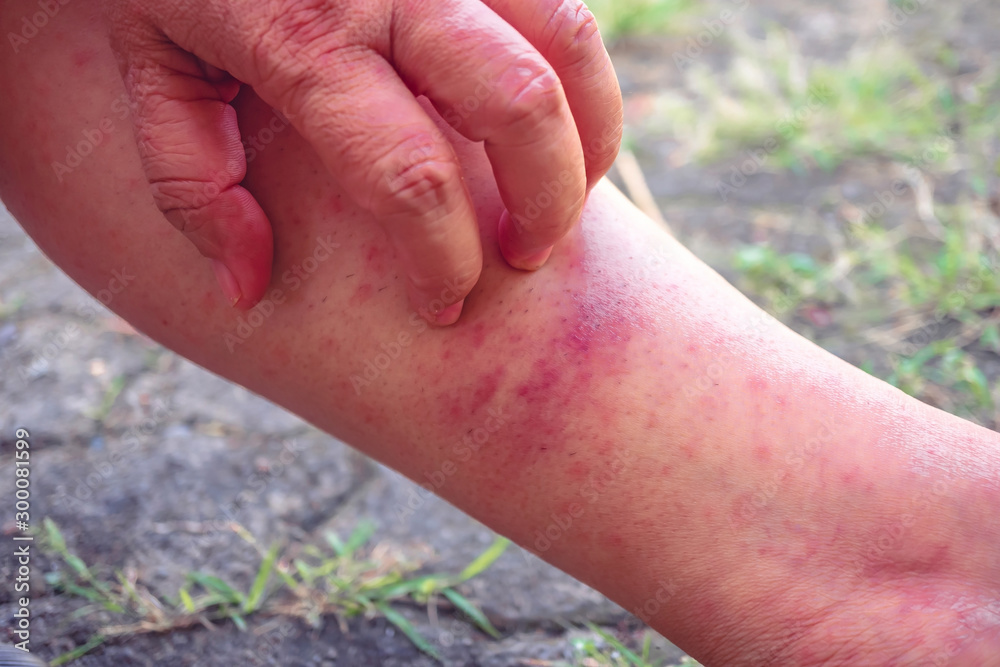 The rash may be caused by a virus., Rash on the legs can be caused by ...