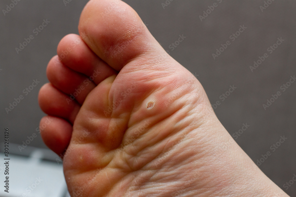 Wart on the foot. Plantar wart on the foot Stock Photo | Adobe Stock