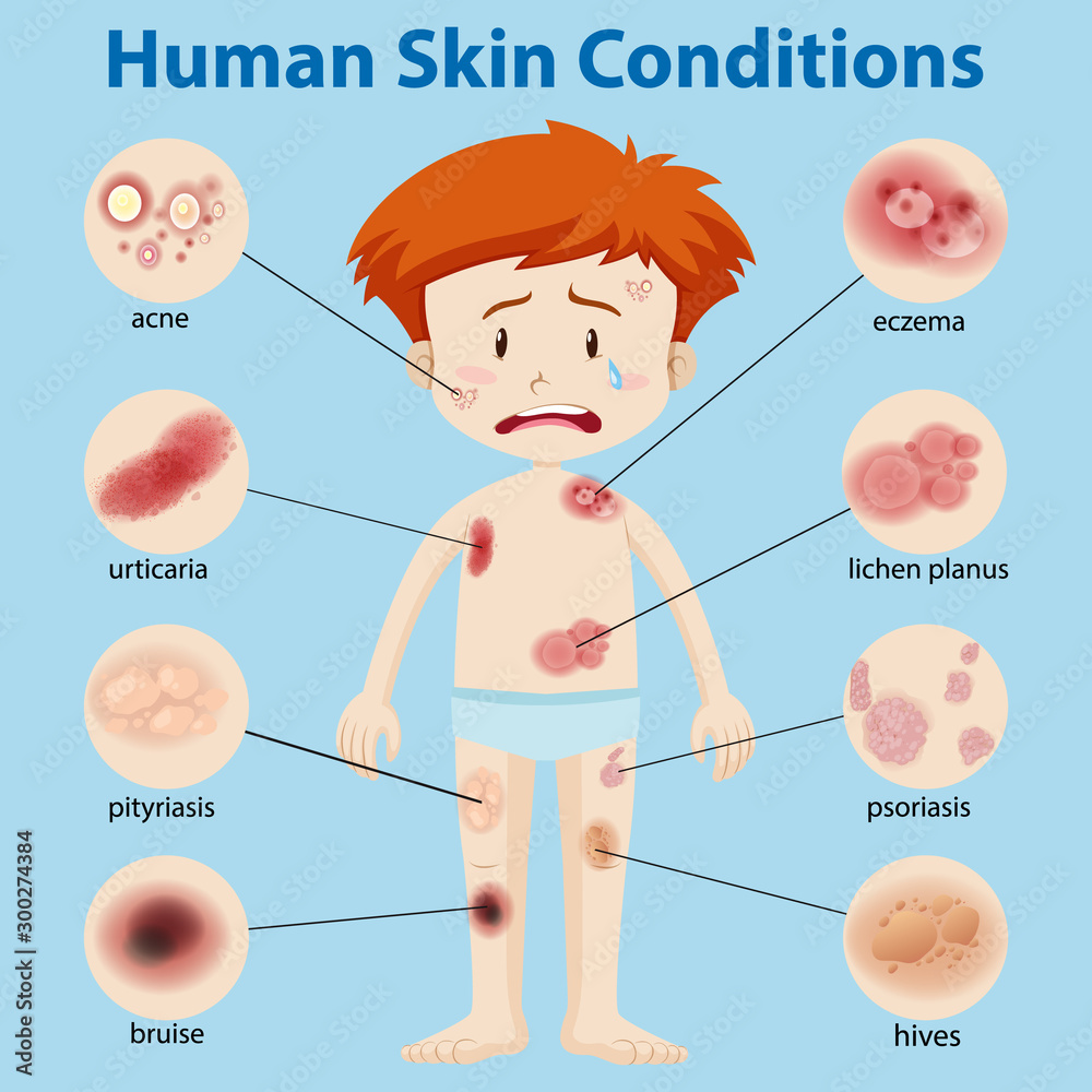 Diagram showing different skin conditions Stock Vector | Adobe Stock Diagram showing different skin conditions Stock Vector | Adobe Stock