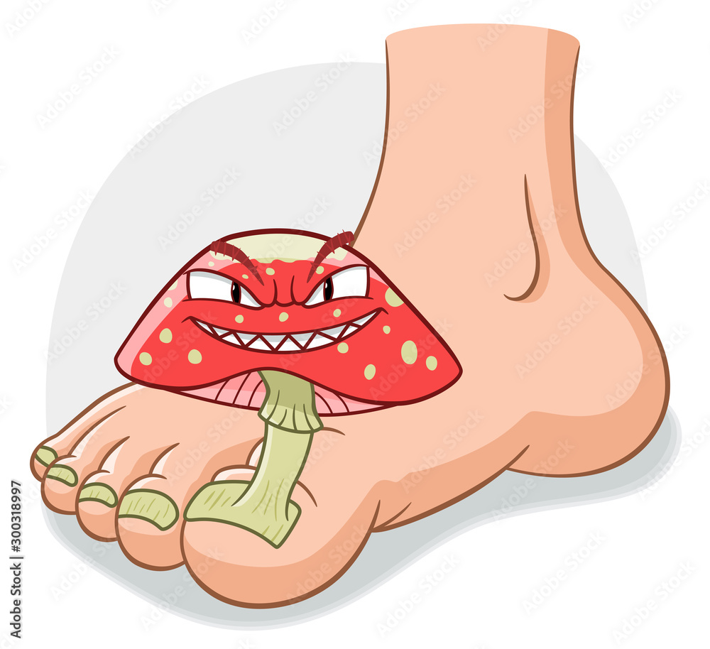 Cartoon foot and nail fungus Stock Vector | Adobe Stock