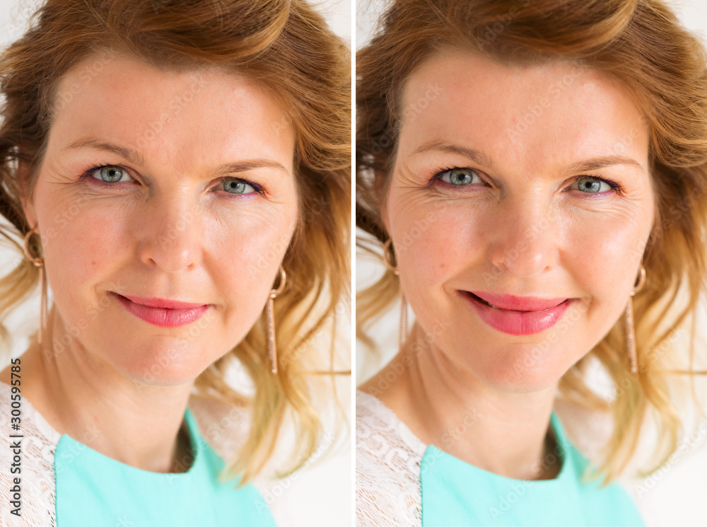 Woman's portrait before and after bigger lips enhancement procedure ...