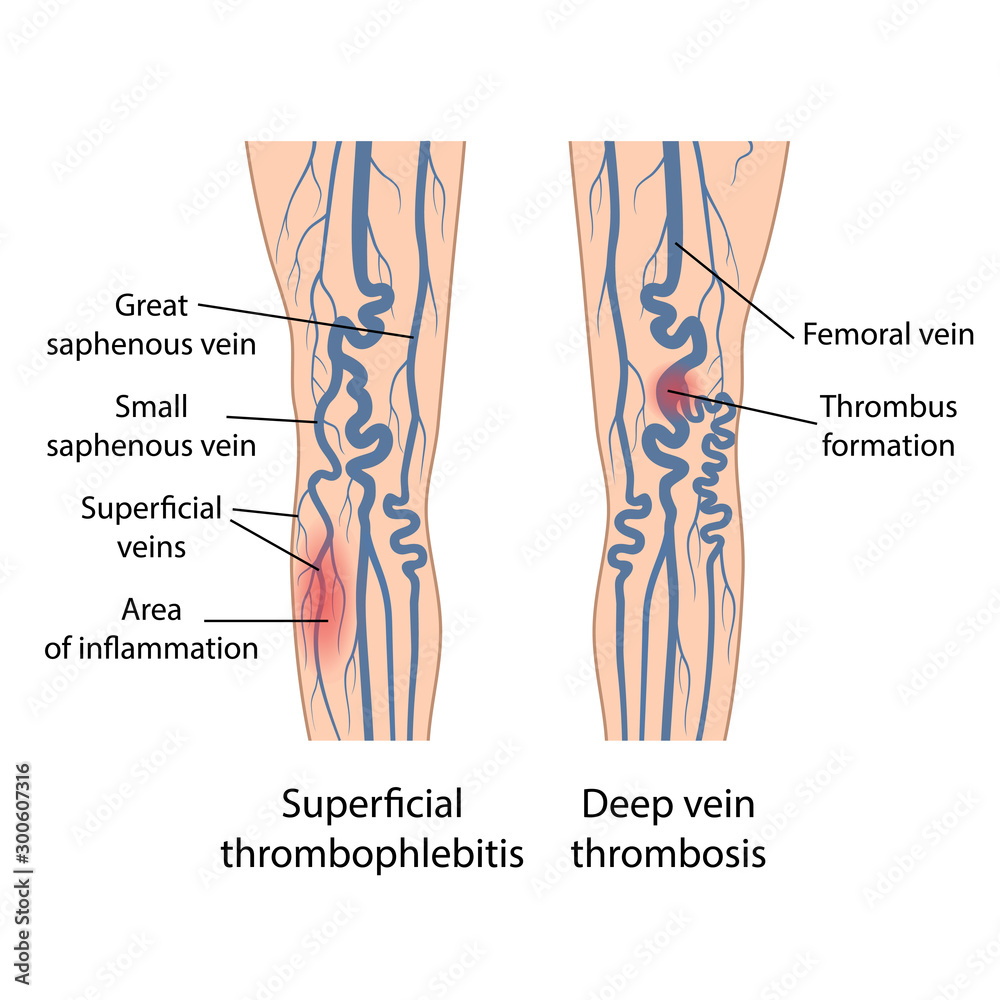 Superficial Thrombophlebitis Of Legs Deep Vein Thrombosis Image Of