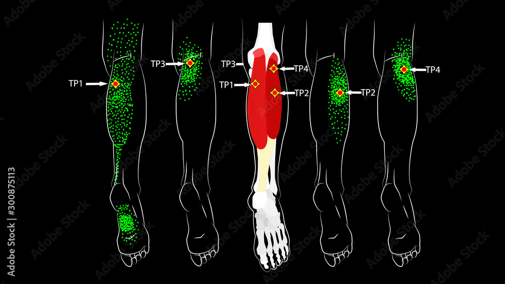 Calf muscle. Trigger points in the leg, reflected pain on the back of ...