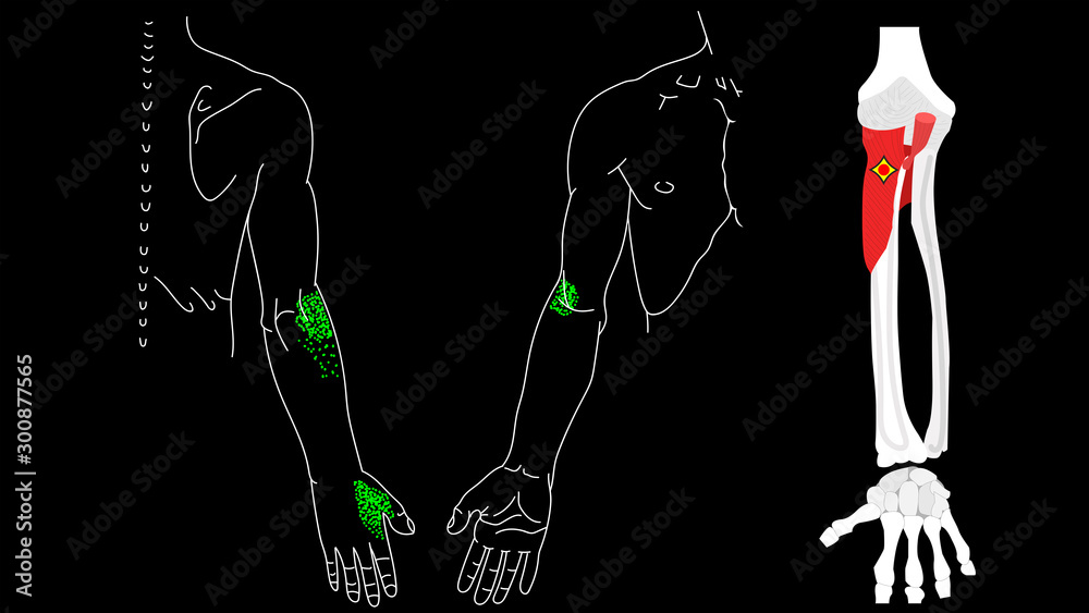 Supinator muscle. Trigger points in the muscles of the hands. Stock ...