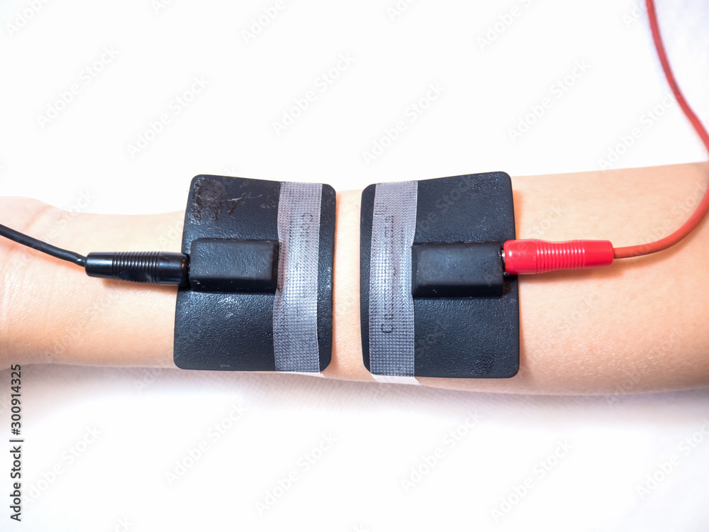 Physical therapist helping with electrical stimulator on the arm for ...