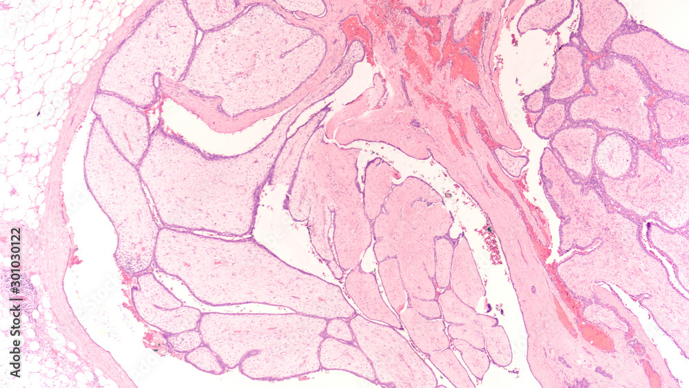 Photomicrograph showing histology of a benign phyllodes tumor of the ...