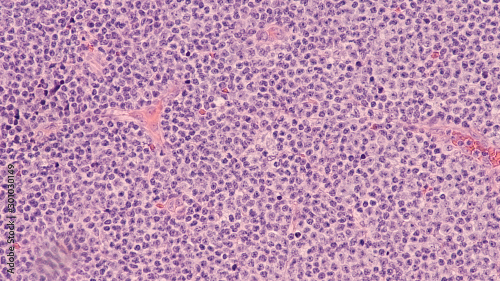 Lymphoma awareness: photomicrograph of a small lymphocytic lymphoma ...