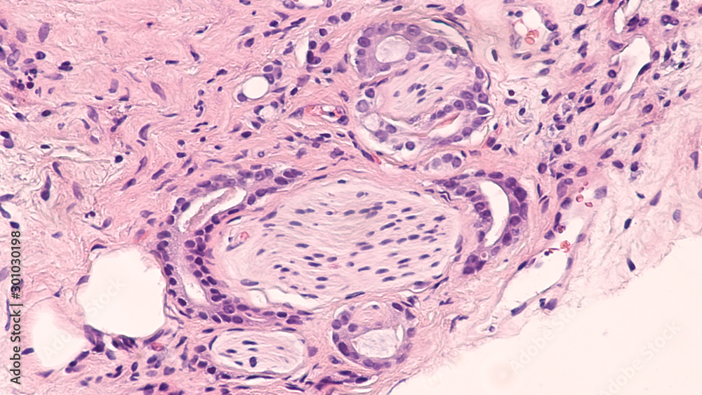 Prostate Cancer Core Biopsy Histology (Pathology): Adenocarcinoma of ...