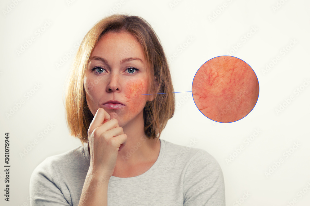 Medicine, cosmetology, rosacea. A blonde woman with rosacea-inflamed ...