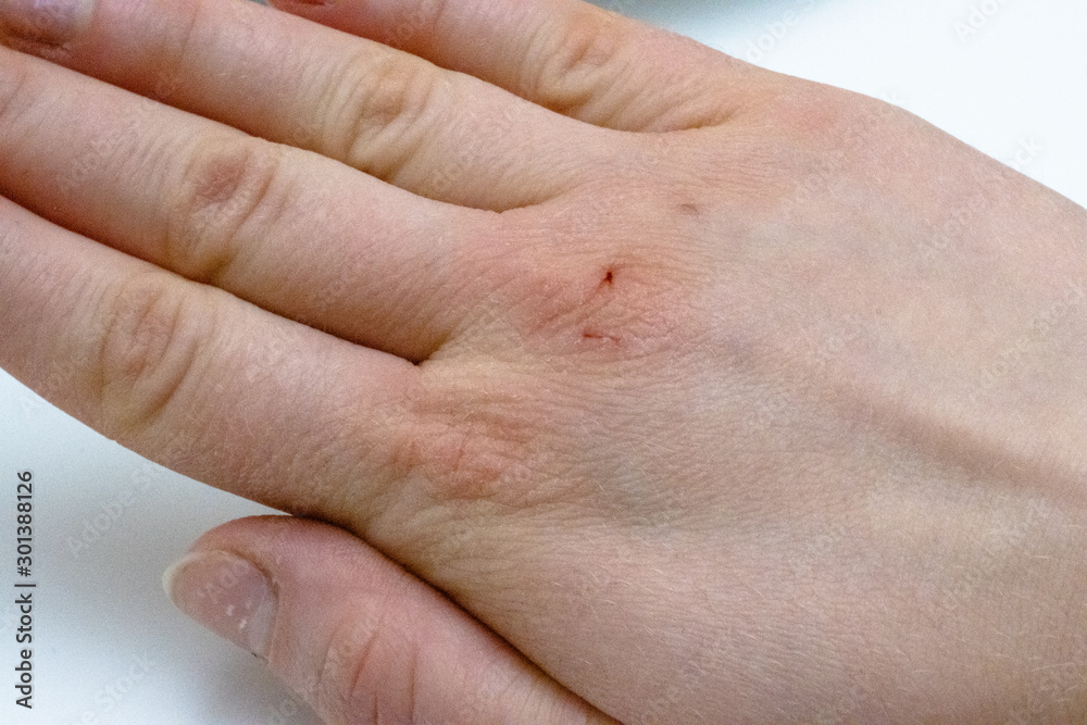 Cracked dry skin on hands under the fingers of a young white woman ...