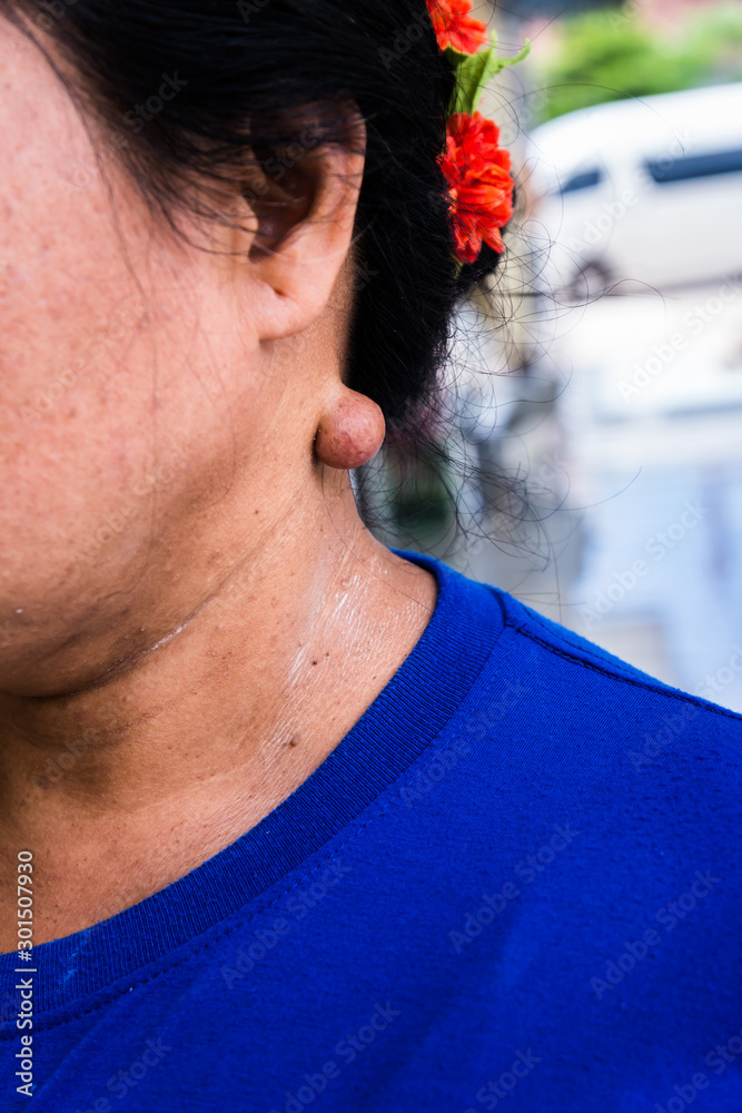 Sebaceous Cyst On The Neck Woman Form Out Of Sebaceous Gland The Oil
