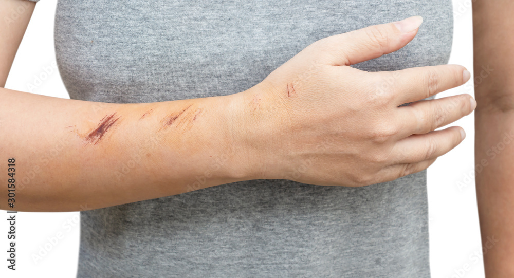 The wound form scabs on hand and arm. The wound happen during woman ...