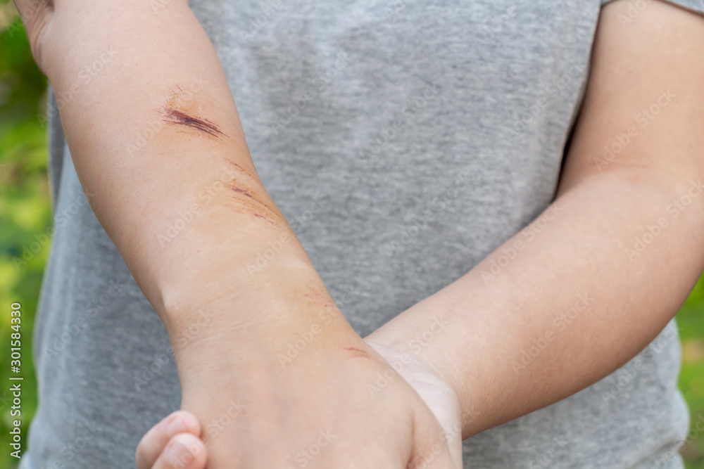 The wound form scabs on hand and arm. The wound happen during woman ...