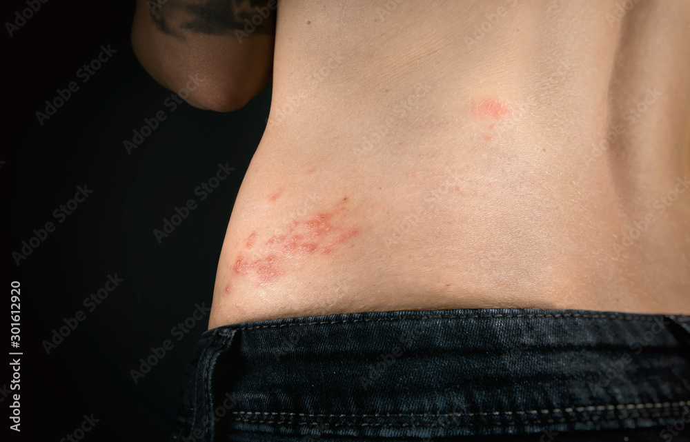 Shingles outbreak on torso of woman. The varicella-zoster virus has ...