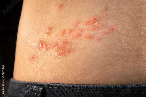 Shingles outbreak on torso. The varicella-zoster virus has formed a red ...