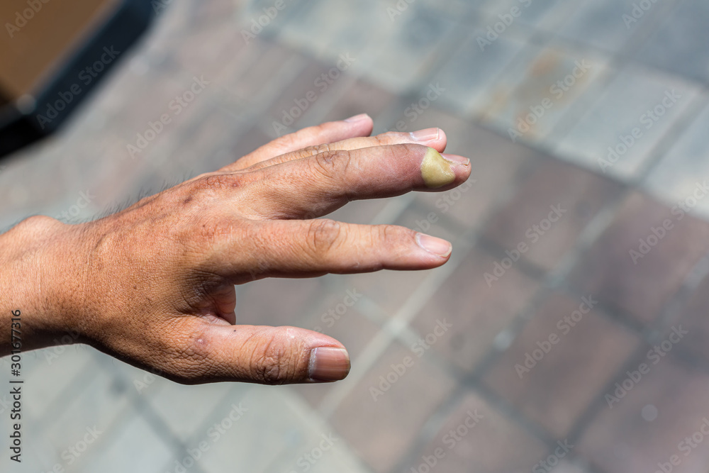 Paronychia, swollen finger with fingernail bed inflammation due to ...