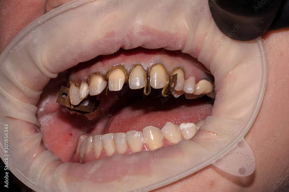 Turning and preparing teeth for ceramic veneers and crowns. Micro ...