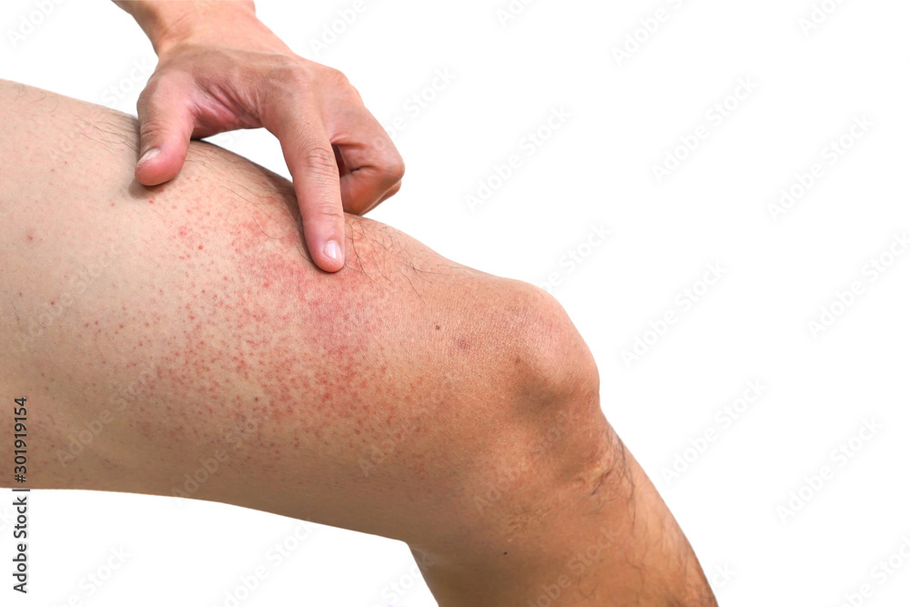 Red rash on leg isolated on white background / Rashes with virus Stock ...