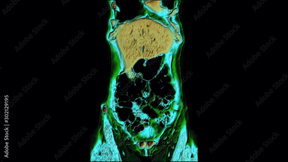 Color contrast MRI of the abdominal cavity, gastrointestinal tract ...