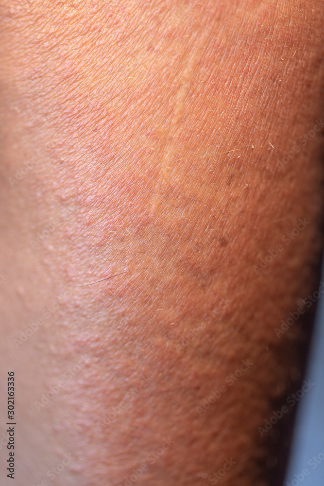 Human skin with sunburn. Stock Photo | Adobe Stock