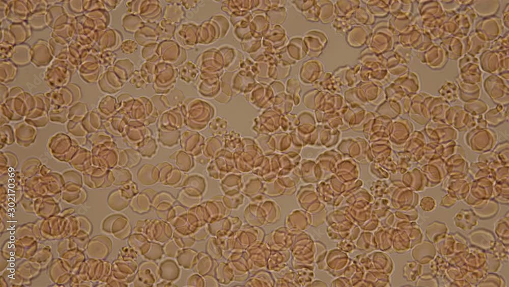 Blood under a microscope, the movement of spur-shaped red blood cells ...