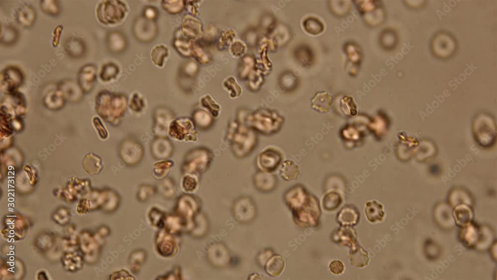 Blood under a microscope, the movement of dead and damaged cells in ...