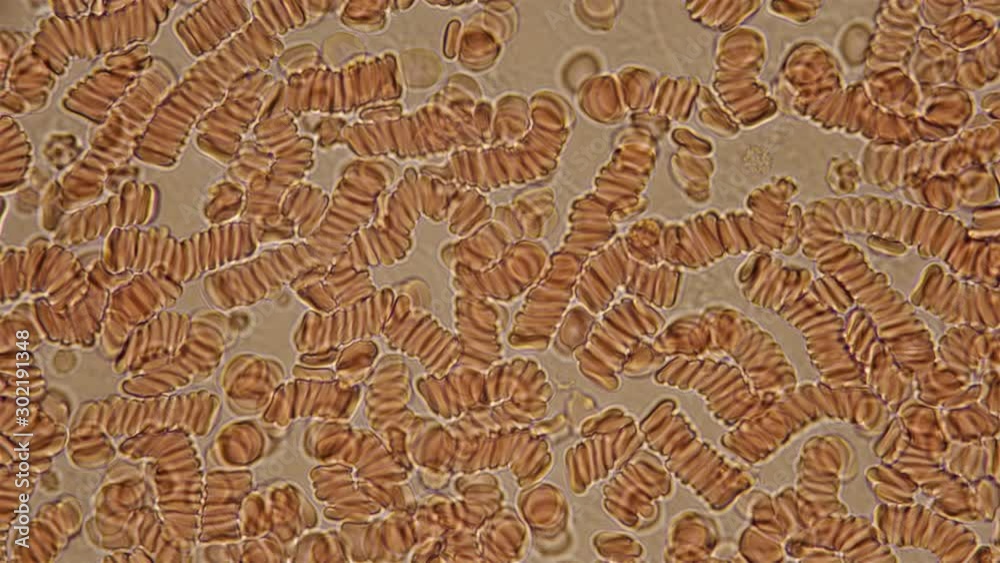 Blood under a microscope, adhering red blood cells in clotted blood ...