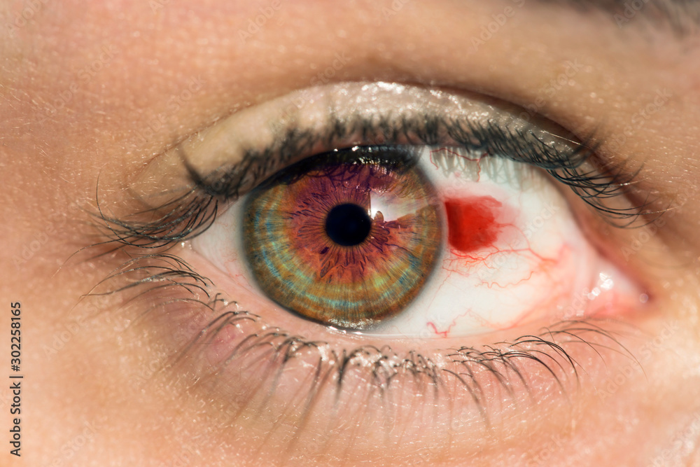 Hemorragia ocular en ojo verde Stock Photo | Adobe Stock