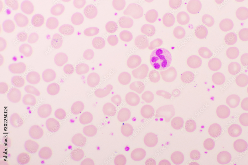 Essential thrombocytosis blood smear, present abnormal high platelet ...