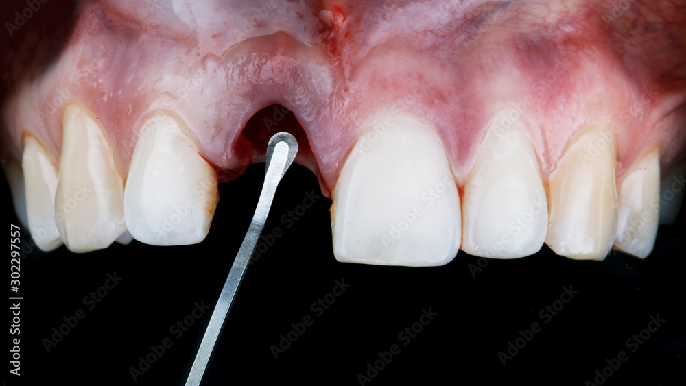 dental instrument and gum after tooth extraction, for implantation ...