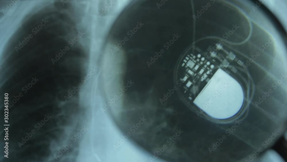 X-Ray Image of Chest with Artificial Cardiac Pacemaker Under Magnifying ...