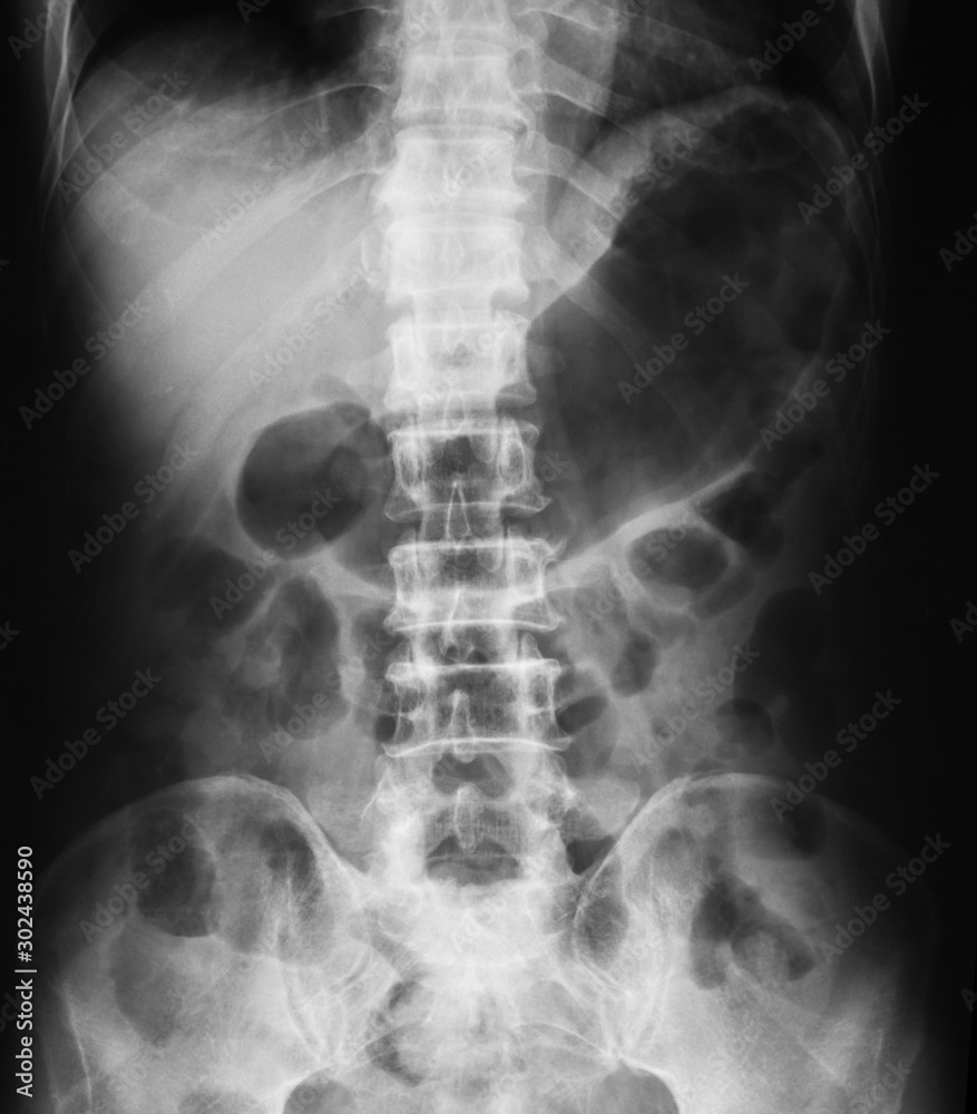 X-ray image of abdomen pain, showing ulcerative colitis, supine ...