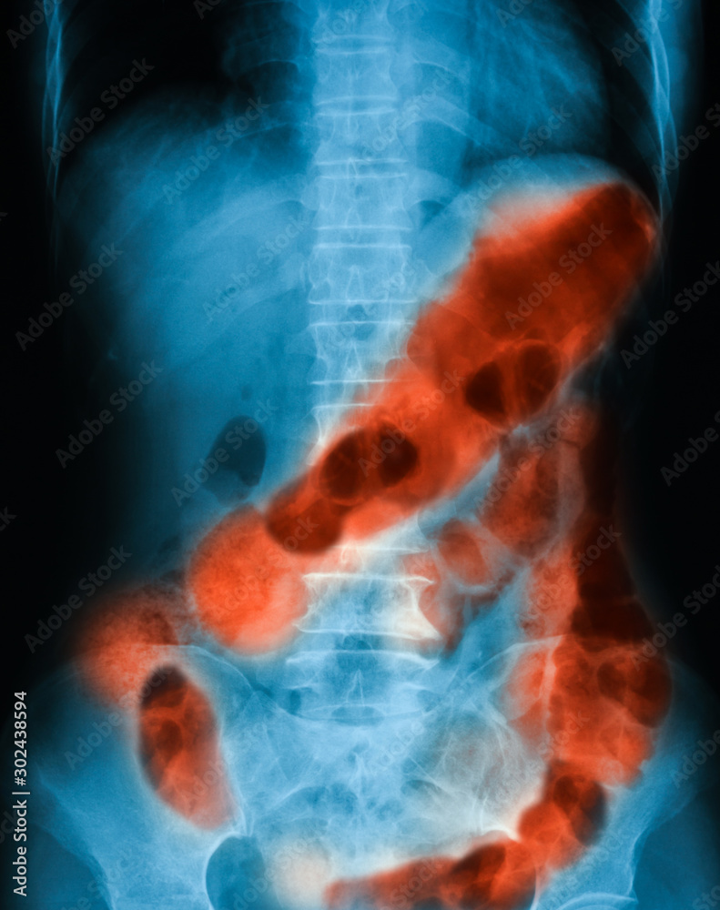 Poster X-ray image of abdomen pain, supine position, showing Ulcerative ...