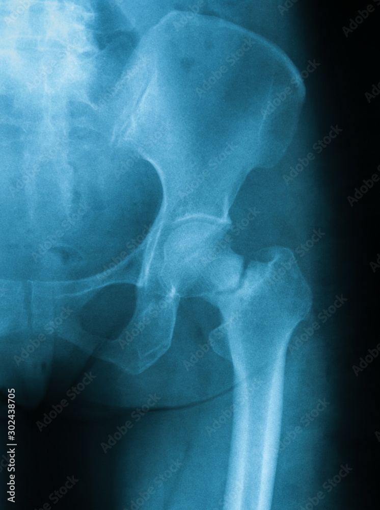 X-ray image of hip joint antero posterior view, showing femoral neck ...