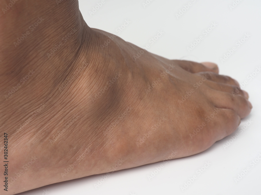 Big ganglion cysts,a sac of jellylike fluid,is on the right foot of man ...