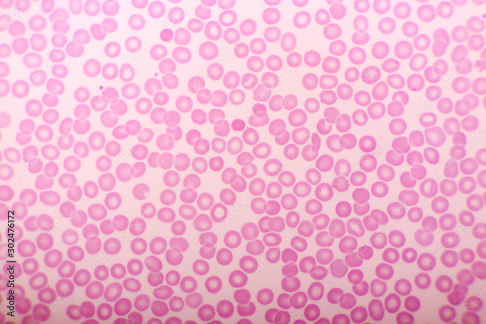 Red blood cells in blood smear, Wright-Giemsa stain, analyze by ...