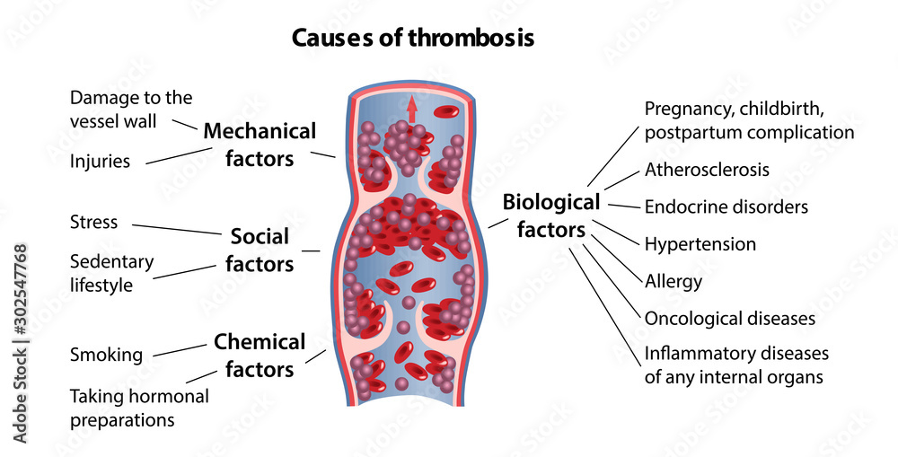 Causes of thrombosis: mechanical, chemical, biological and social ...