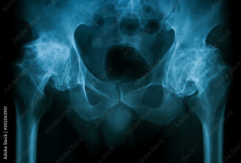 X-ray image of both hip, AP view, Showing both hip osteoarthritis ...